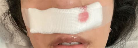 Done And Over With Rsinusitis