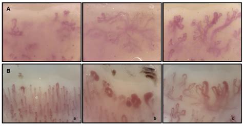 Nailfold Microangiopathy In Dermatomyositis And Systemic Sclerosis