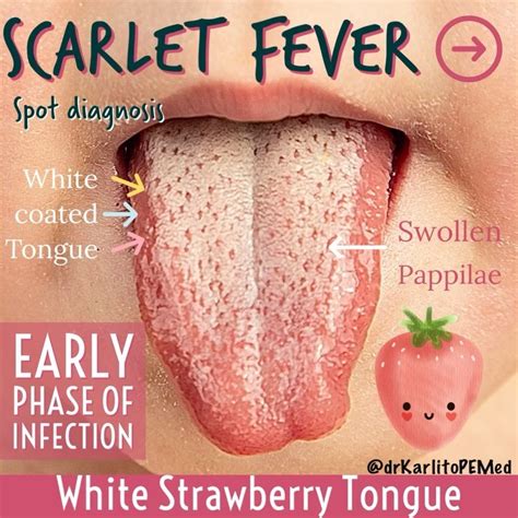 White Strawberry Tongue