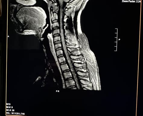 Radiologist Could Not Determine If This Was Artifact Or Not Rmedical