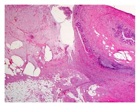 Histological Picture Of Ruptured Diverticulum Note That Localized