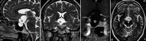 Surgical Neurology International