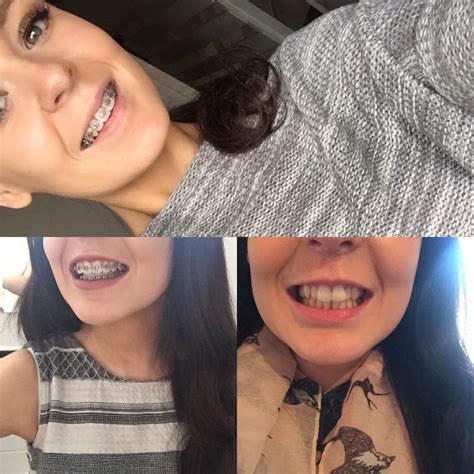My Experience With Braces So Far Lauren Morgan
