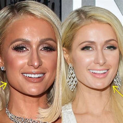Paris Hilton Cheek Implant International Plus
