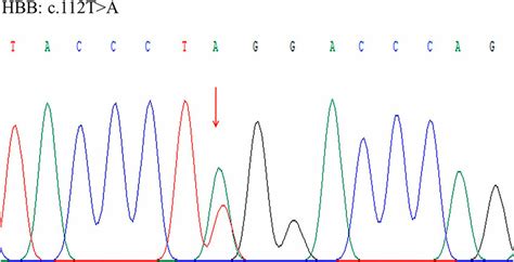 Sanger Sequence Identified Heterozygosity For A Mutation Of The