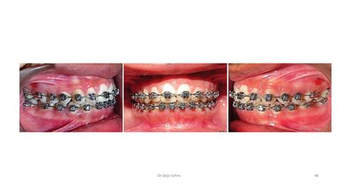 Infra Zygomatic Crest Implants Izc Pptx Dental Health Diseases
