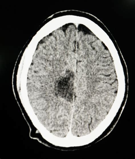 Tumefactive Demyelinating Lesion Pacs