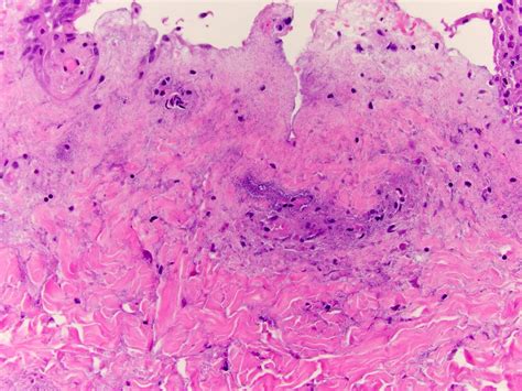 Ecthyma Gangrenosum Histology Ulceronecrotic Rash In An