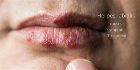 입술 포진 빠르게 치유하는 자연 요법 4가지 Olafskin