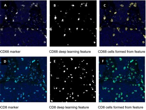 Spatial Phenotyping In Digital Pathology Defining A Multiplex If Image Analysis Workflow To