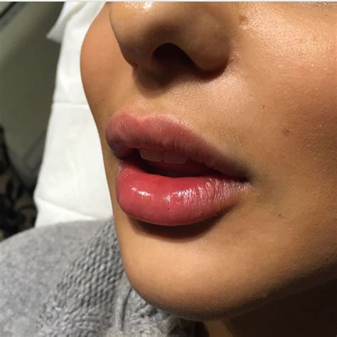 Perfect Lip Fillers Perfect Lips Lip Fillers Botox Lips