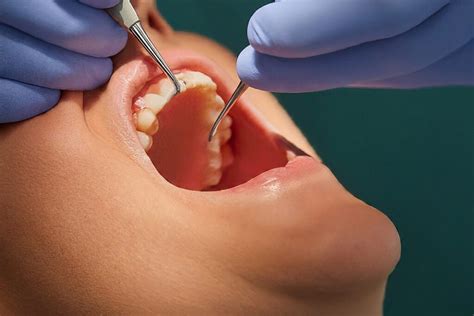 The Operculectomy Procedure Explained Dental 3du