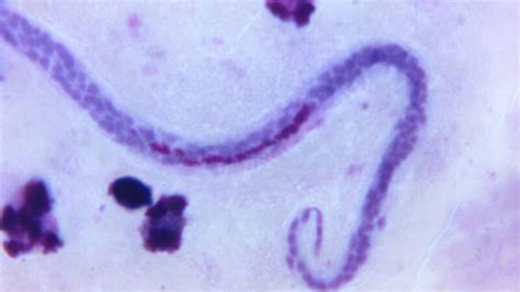 Parasitic Worms Twirl And Dance In A Mans ‘scrotum Gadgetany