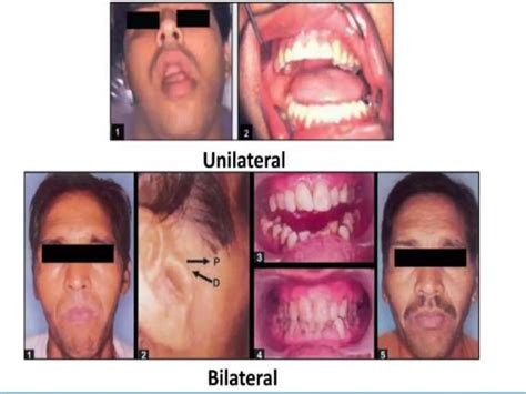 Clinical Features Presentation Clinical And Surgical Management Of Tmj Dislocation Ppt