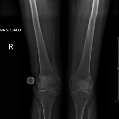 Pdf Measuring Lower Limb Alignment And Joint Orientation Using Deep Learning Based