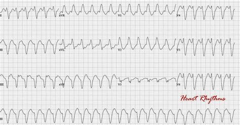 Ecg Rhythms Wide Qrs Tachycardia