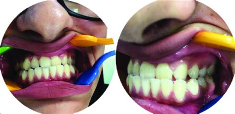Prognathism Of Mandible And Class Iii Relationship Download Scientific Diagram