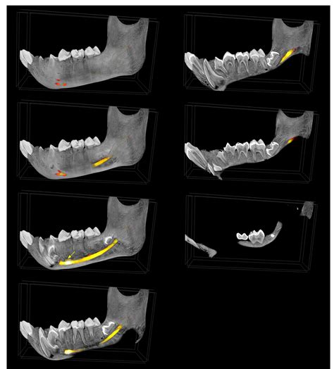 A 3d Visualization With Marked Mandibular Canal Course And