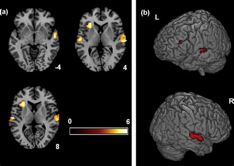 Brain Regions With Significant Activity Of Auditory Perception Of Download Scientific Diagram