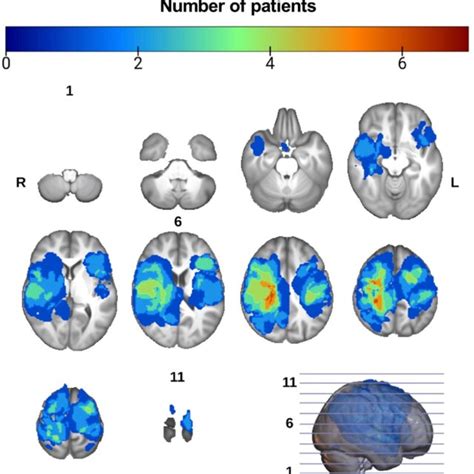Spatial Distribution Of Lesions From All Patients Overlaid Onto The Uk