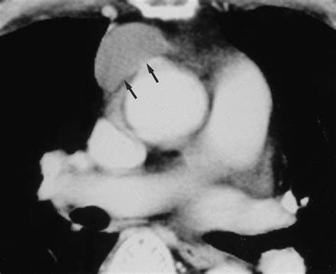 Thymic Cyst Vs Thymoma At Makayla Moffatt Blog