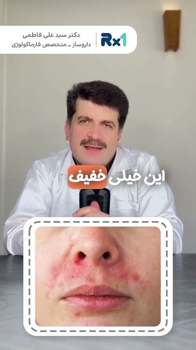 آیا بعد از قطع مصرف روآکوتان، جوش‌ها برمی‌گردن؟ Youtube