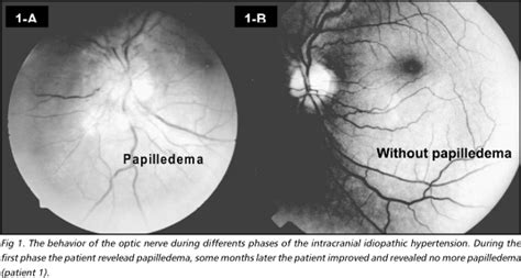Papilledema Vs Normal