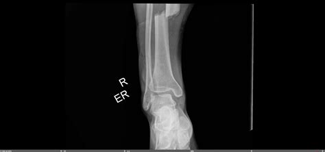 Tibia Shaft Fracture Chicago Foot Ankle Orthopaedic Surgeons