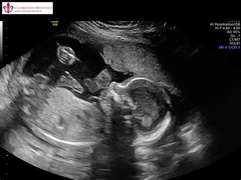 Ultrassonografia Placenta Previa Placenta Obgyn Key