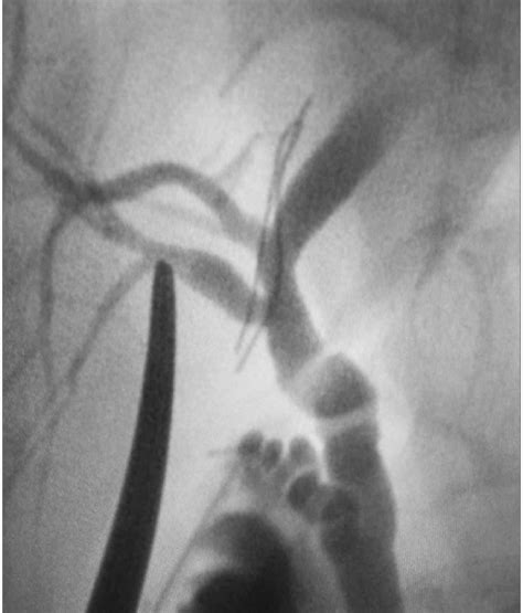An Intraoperative Cholangiography During The Same Operation In Fig 1
