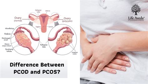 Difference Between Pcod And Pcos