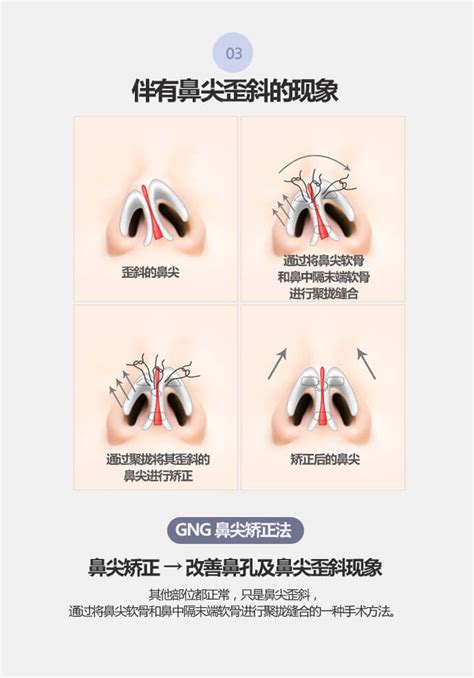 歪鼻 鼻炎 鼻塞 鼻中隔弯曲 韩国gng医院 整形外科 耳鼻喉科