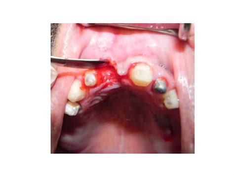 Soft Tissue Augmentation Ppt