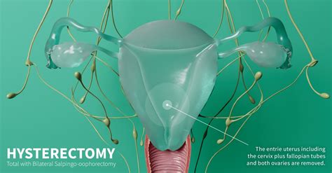 Robotic Total Hysterectomy With Bilateral Salpingo Oophorectomy Cpt Code At Virginia Nealon Blog