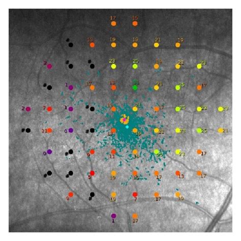 A B Left And Right Goldmann Visual Fields Showing Central Download Scientific Diagram