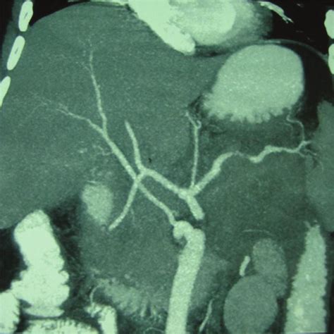 Severity Of Ap Based On Modified Ctsi Score Download Scientific Diagram