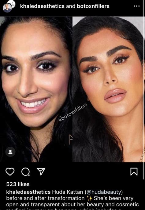Mona And Huda Kattan Before The Surgery Rdubaibling