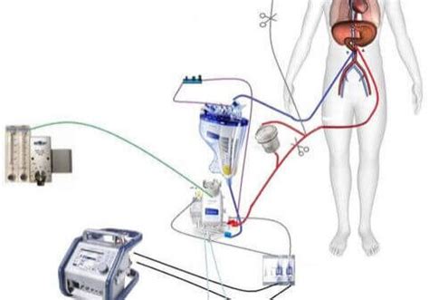 Revolutionizing Organ Preservation Keystone Perfusion Services