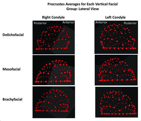 Evaluating Condylar Head Morphology As It Relates To The Skeletal