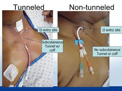 Non Tunneled Central Venous Catheter