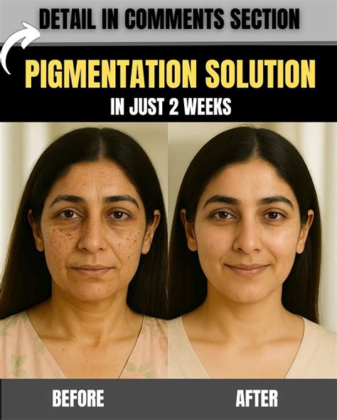 Pigmentation Solution In Just 2 Weeks With These Home Remedies V Beautify
