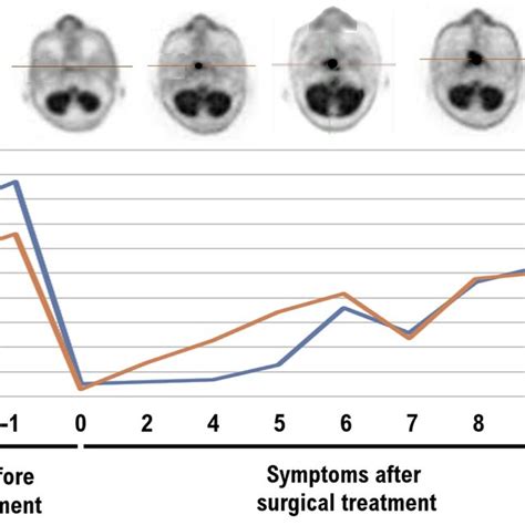 Early Diagnosis Of Advanced Recurrent Malignant Tumors By The Detection