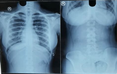 Chest Radiograph Pa View And Abdominal Radiograph Erect Taken On