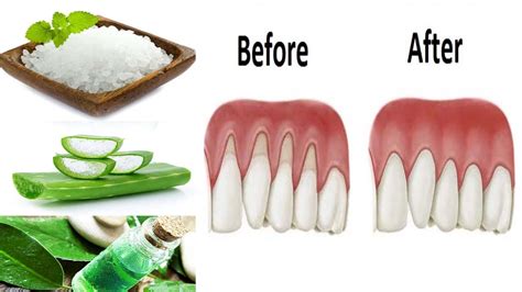 How To Make A Blister On Your Gums Go Away At Douglas Borba Blog