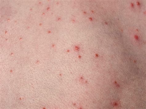 Pimple On Butt How To Identify And Treat Butt Bumps