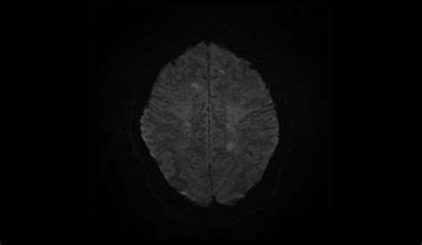 Multiple Sclerosis Ms Mri Radiology Article On Multiple Sclerosis