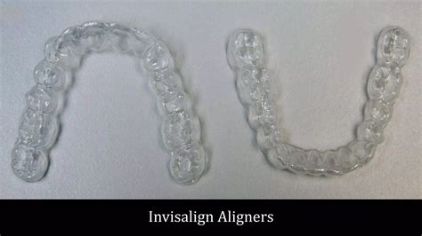 What Is Teeth Spacing Its Causes And Cures Pptx