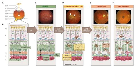 Age Related Macular Degeneration