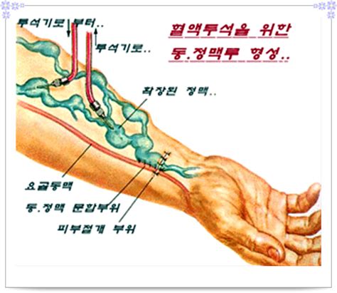 혈액투석을 위한 동정맥루 형성 네이버 블로그