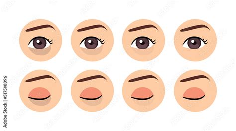Dark Circles Under The Eye Female Open And Closed Eye Treatment Of